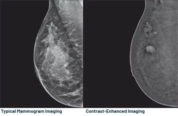 Contrast-enhanced mammography | Providence St. Mary Foundation
